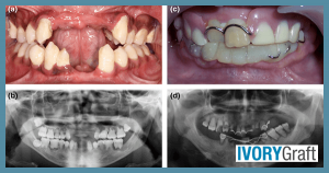 Dentin - Pathologies - Ivory Graft